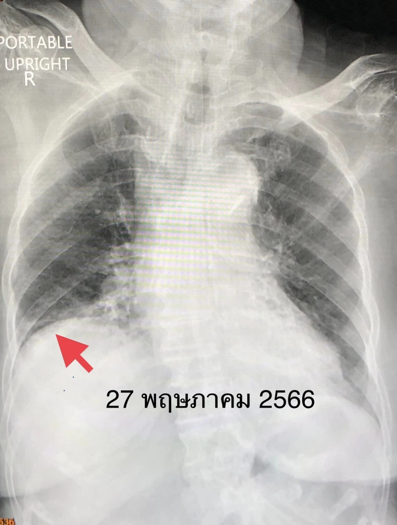'หมอมนูญ' เผยเจออีก 1 คน ผู้สูงอายุติด โควิด-19 XBB วันเดียวเสมหะมากจน ปอดแฟบ
